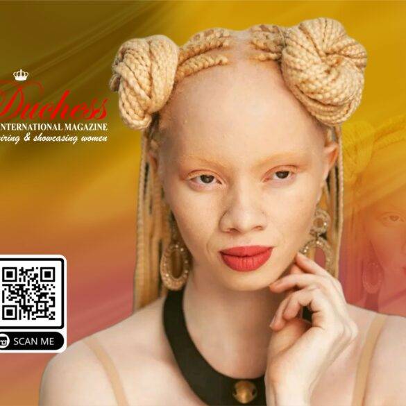 Albinism Archives | Duchess International Magazine